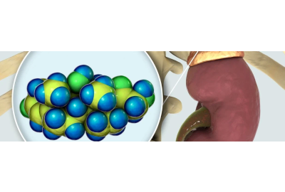 Boala Whipple: o afectiune rara care genereaza tulburari digestive. De ...