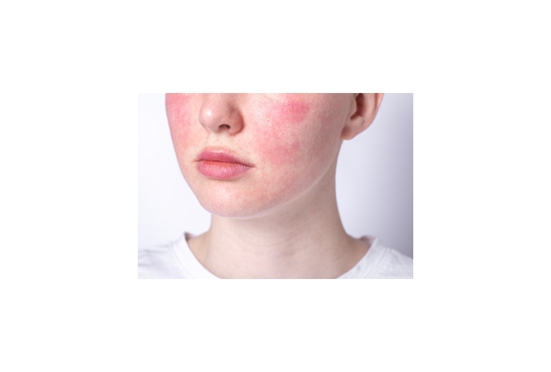 Totul despre pete rosii pe piele