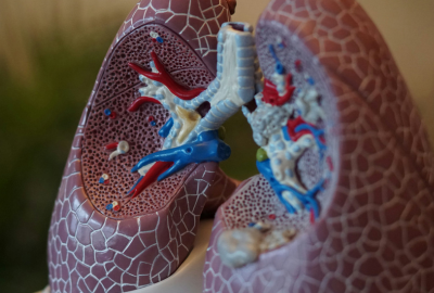 Edemul pulmonar: cauze, simptome si optiuni terapeutice