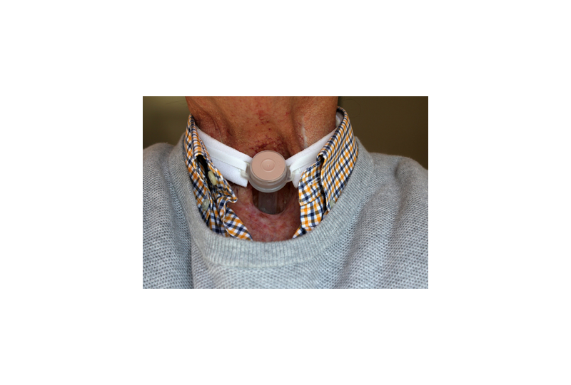 Cancerul de esofag: cauze, simptome, diagnostic, cum se poate gestiona