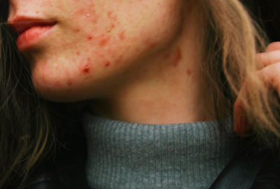 Furunculoza: cauze, simptome, optiuni de tratament si preventie