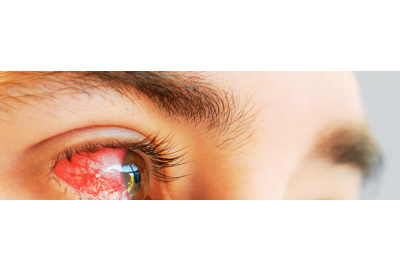 Infectia stafilococica oculara: Cum apare boala, metode de preventie si ...