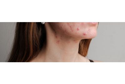 Acneea: cauze, tipuri, tratament, preventie
