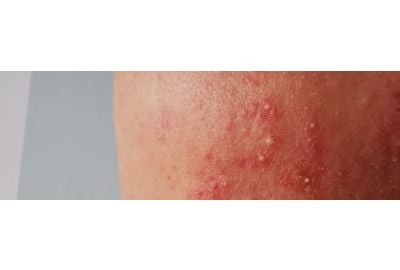 Cuperoza: cauze, tratament, preventie