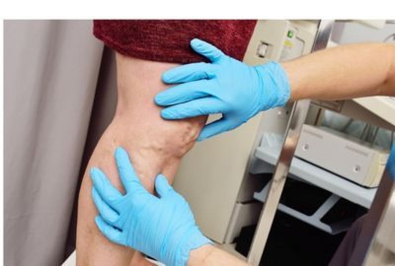 Flebita sau tromboflebita - despre inflamatia peretelui venos