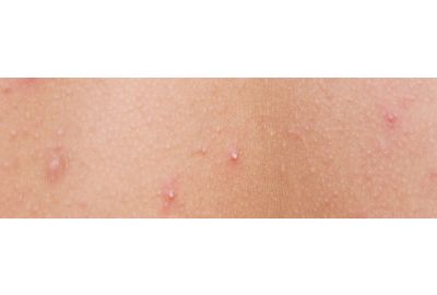 Furuncul: cauze, diagnostic, tratament