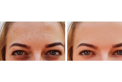 Pungile de sub ochi - ce sunt, de ce apar, remedii