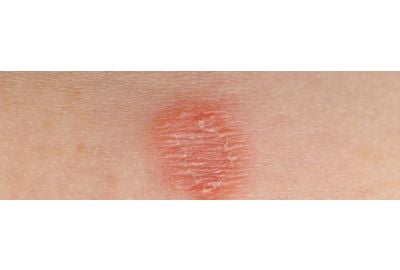 Tricofitie sau Pecingine: De ce apare boala, cum se poate evita, tratament