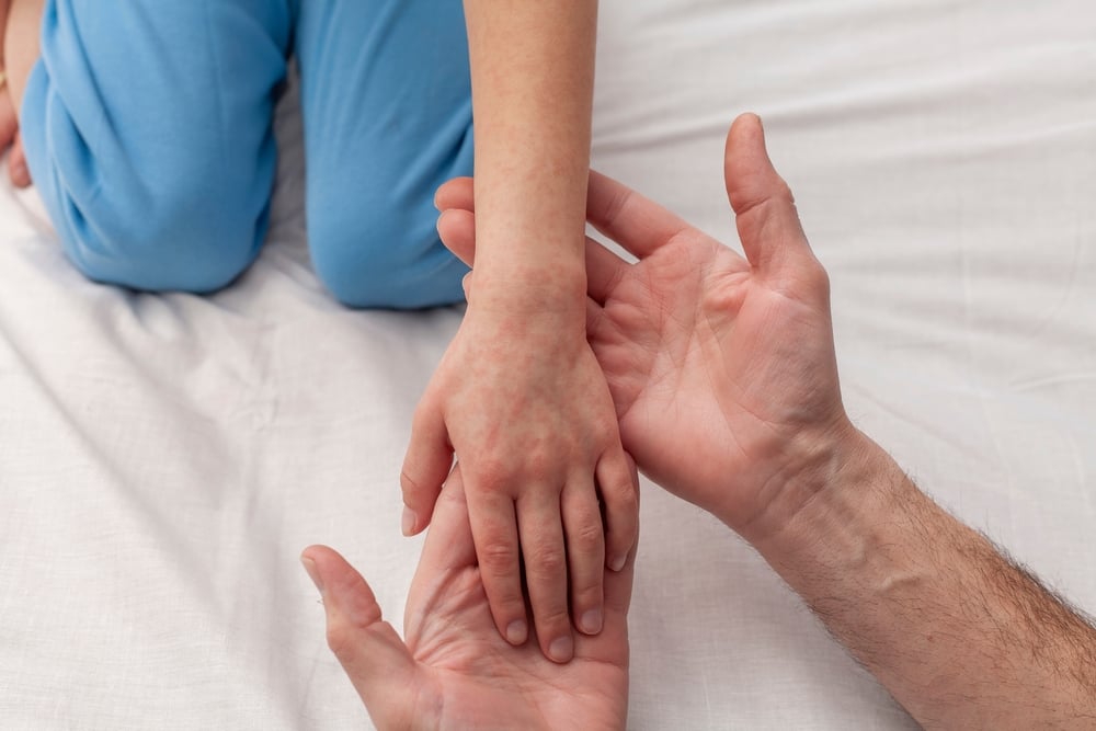 Rubeola la copii si adulti: simptome, cauze si tratament complet