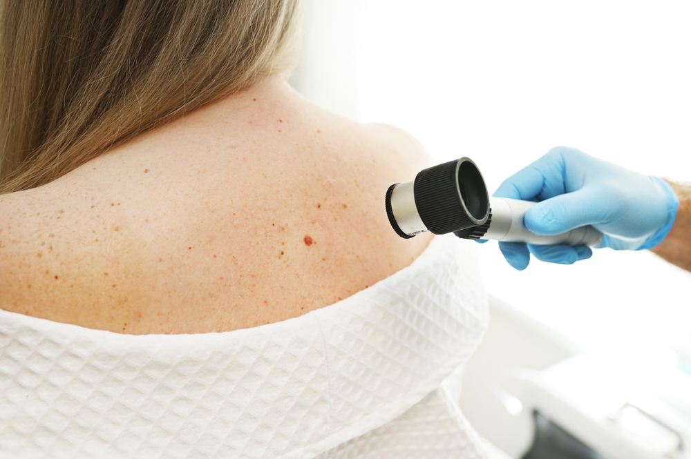 Melanom malign: simptome, diagnostic si tratament complet. Ghid cancer ...